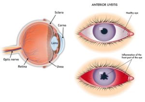 Uveal Diseases – Jaya Eye Care Centre is an NABH Accredited Eye Care ...